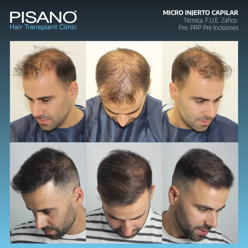 Perdida de cabello en Hombres - Clinica de Injerto Capilar